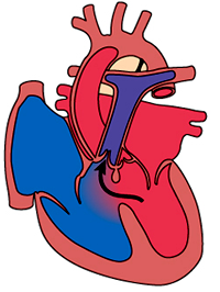 LEFT TO RIGHT SHUNT LESIONS - RME